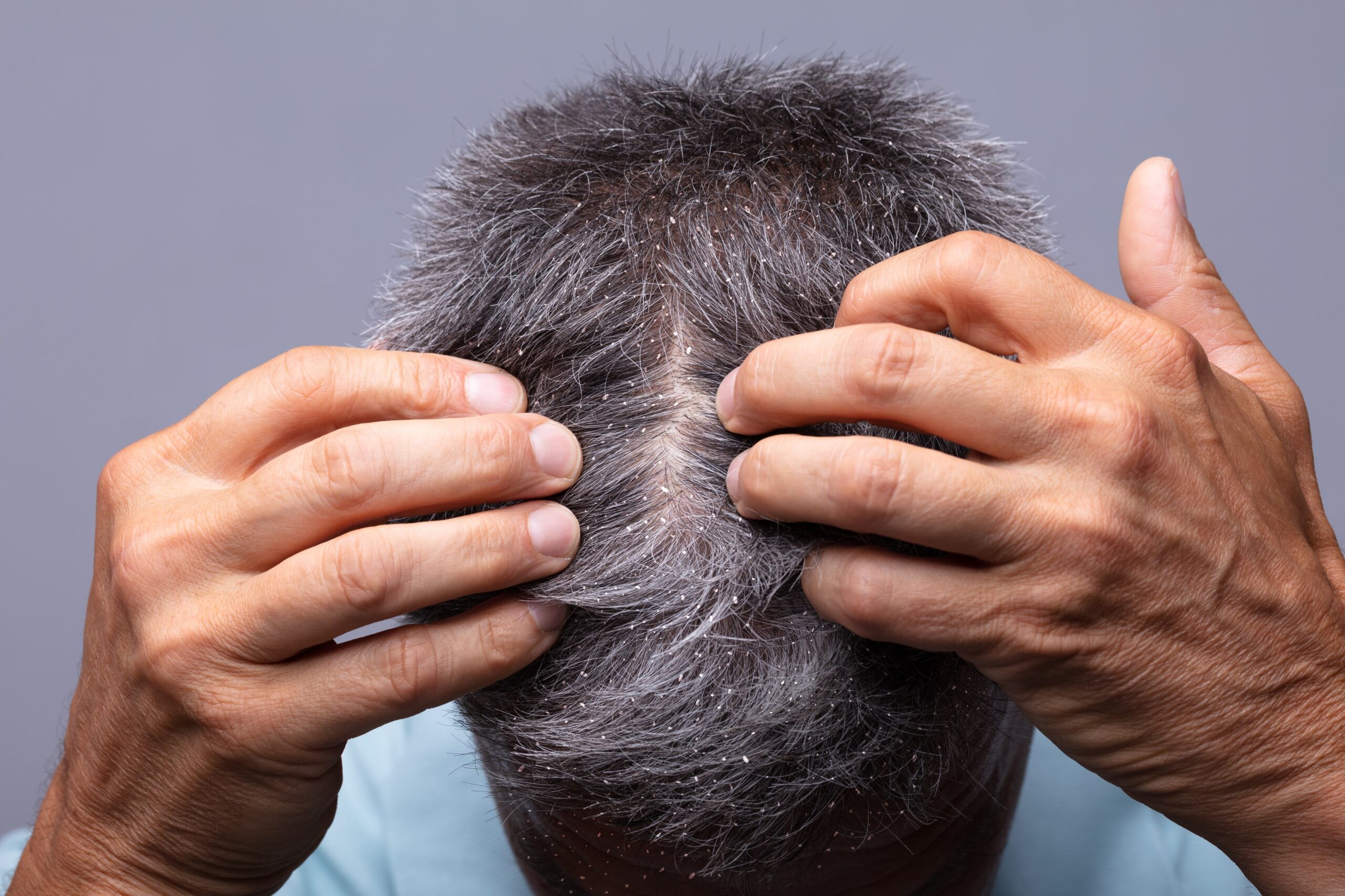 Can Dandruff Cause Hair Loss Orange County
