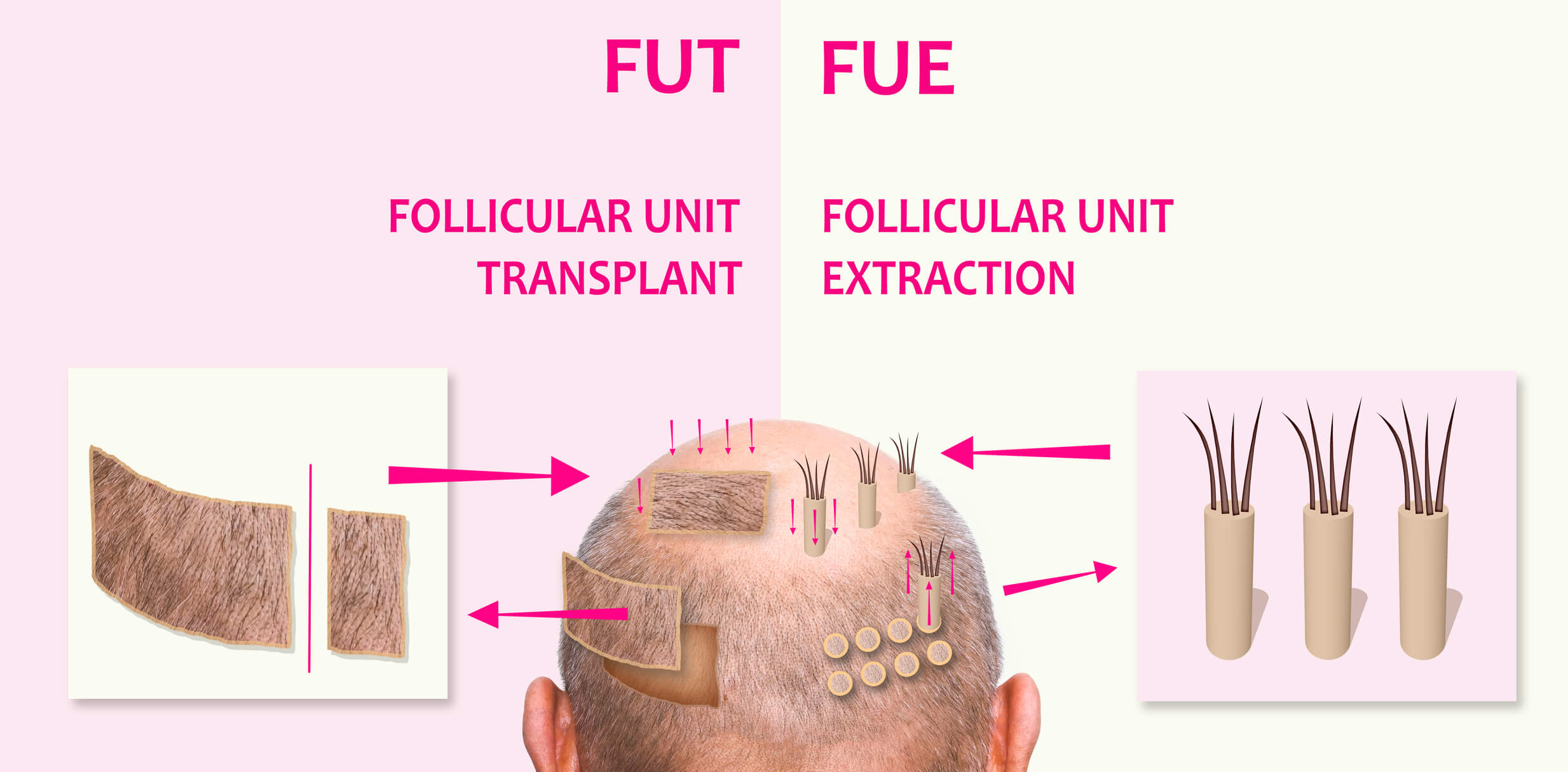 FUE vs FUT Hair Transplant: Which is Right for You?