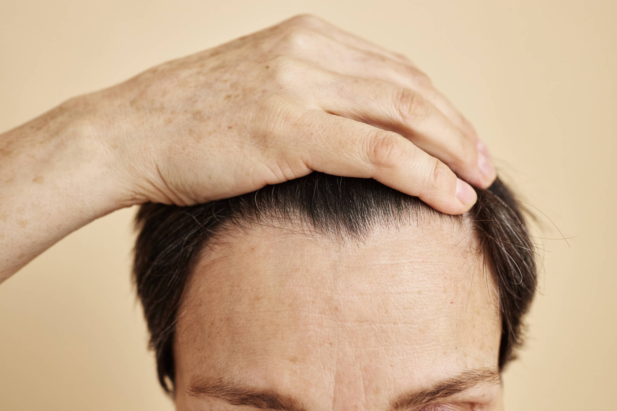 Neograft Hair Restoration in Newport Beach, Orange County, CA